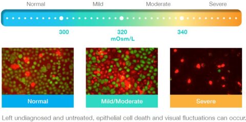 TearLab® - Labtician Ophthalmics