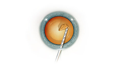 MST Microsurgical Instruments - Labtician Ophthalmics